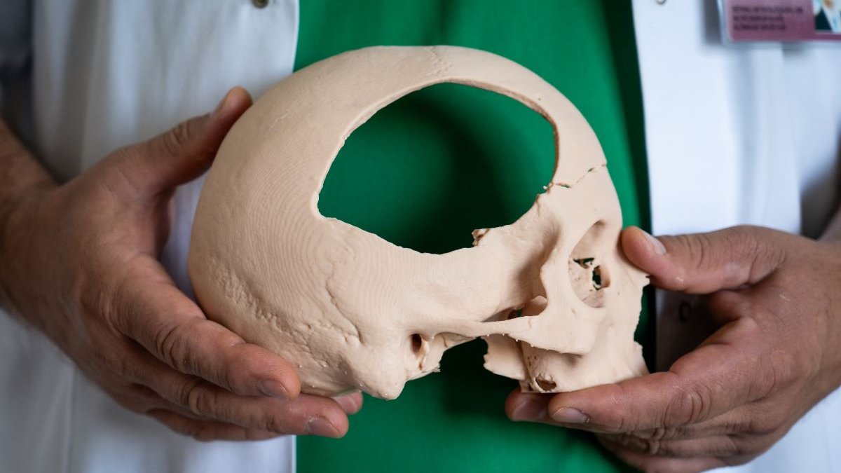 Bērnu slimnīcā izglābj pacientu, daļu galvaskausa aizstājot ar 3D ...